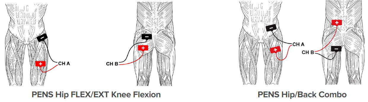 Treating Hip External Rotators and Abductors to Improve Function