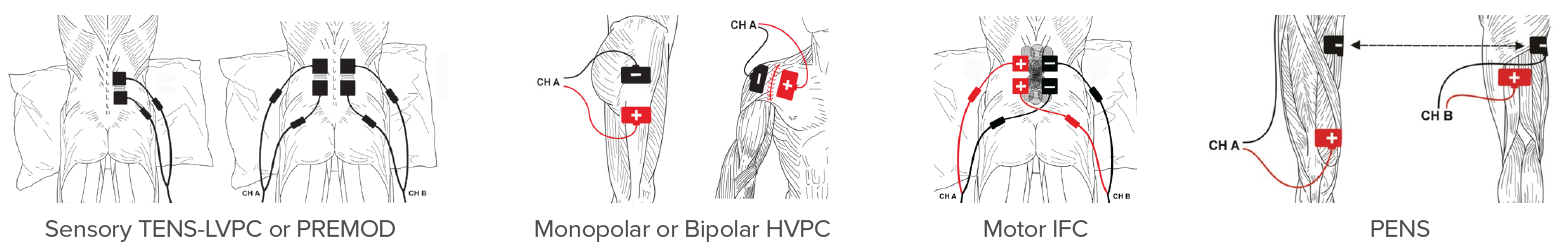 Electrical Stimulation in Pain Management