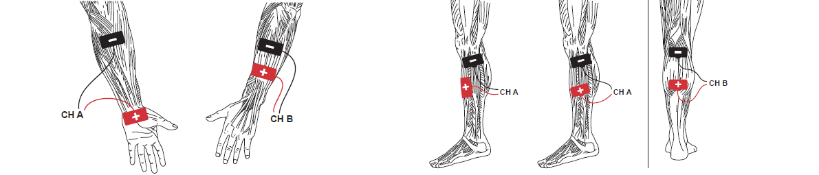 Electrical Stimulation Intervention to Treat Stroke Related Impairments