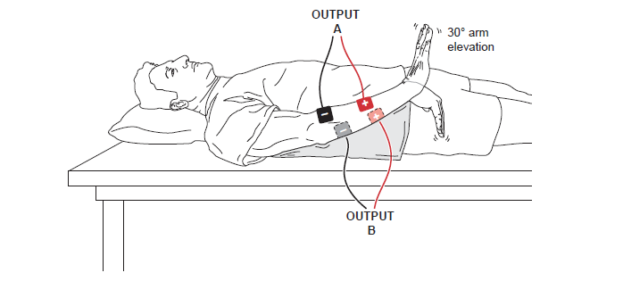 Electrical Stimulation Intervention to Treat Stroke Related Impairments